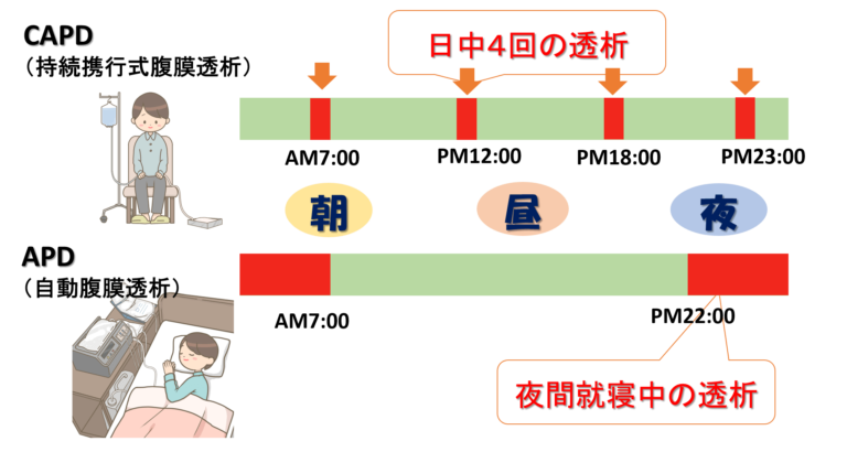 腹膜透析とは｜血液透析との比較、メリット、合併症、費用などを解説 | ぴんころ